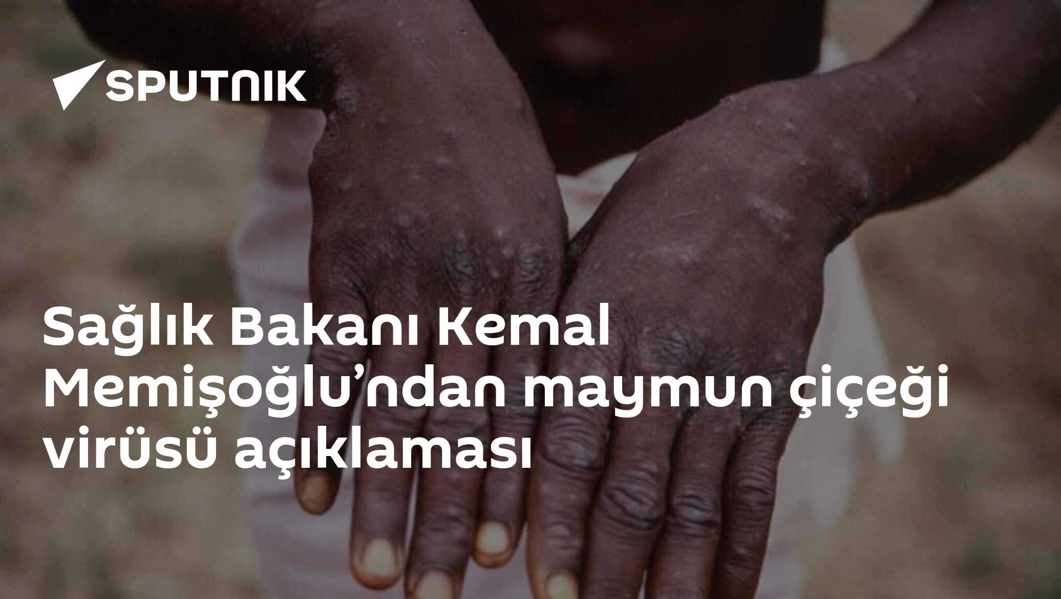 Sağlık Bakanı Kemal Memişoğlu’ndan maymun çiçeği virüsü açıklaması - 14 ...