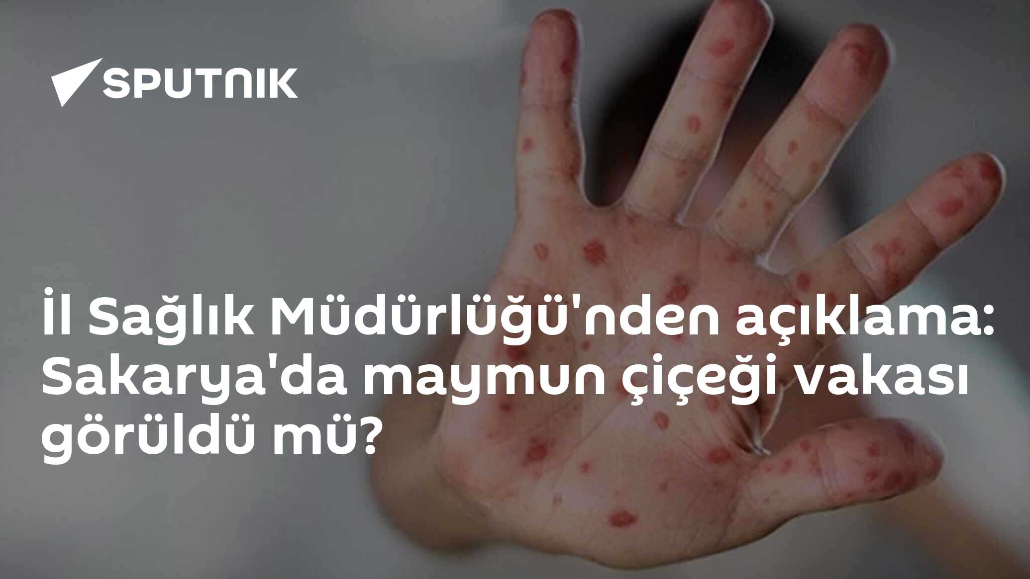 İl Sağlık Müdürlüğü'nden açıklama: Sakarya'da maymun çiçeği vakası ...
